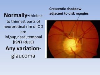 Primary open angle glaucoma | PPTX