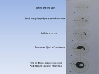 Primary open angle glaucoma | PPT