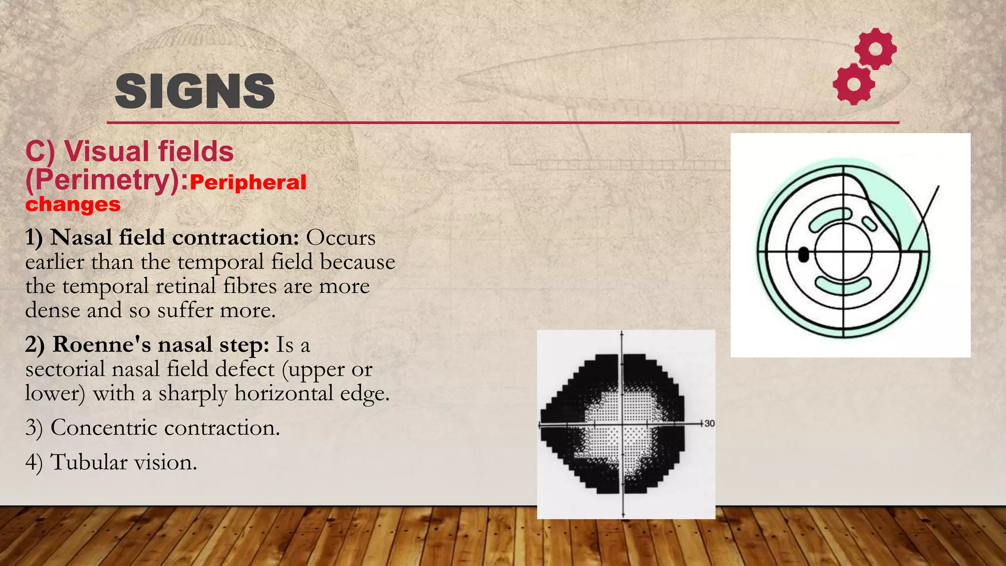 Primary open angle glaucoma | PPTX