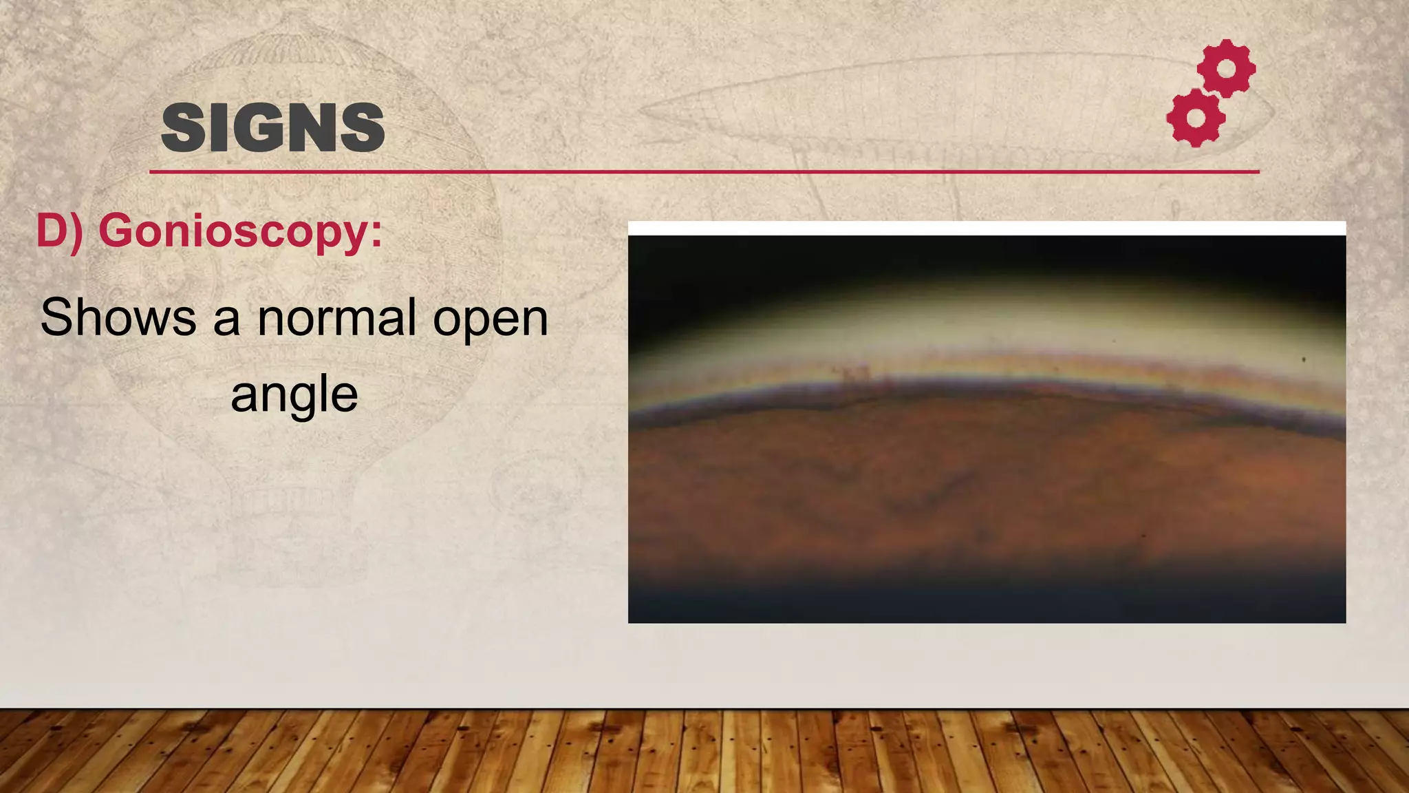 Primary open angle glaucoma | PPTX