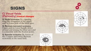 Primary open angle glaucoma | PPTX