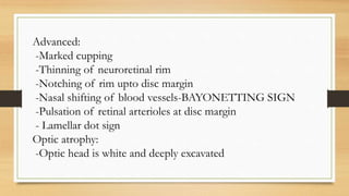 Primary open angle glaucoma | PPTX