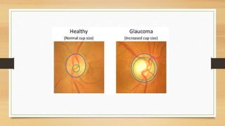 Primary open angle glaucoma | PPTX