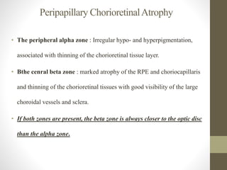 PRIMARY OPEN ANGLE GLAUCOMA - Copy (2).pptx
