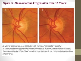 PRIMARY OPEN ANGLE GLAUCOMA - Copy (2).pptx