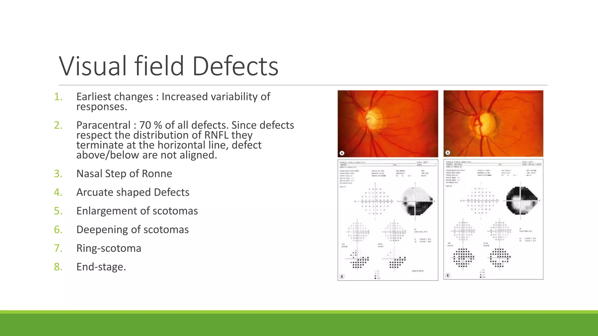 Primary open angle glaucoma, normotensive glaucoma & | PPTX