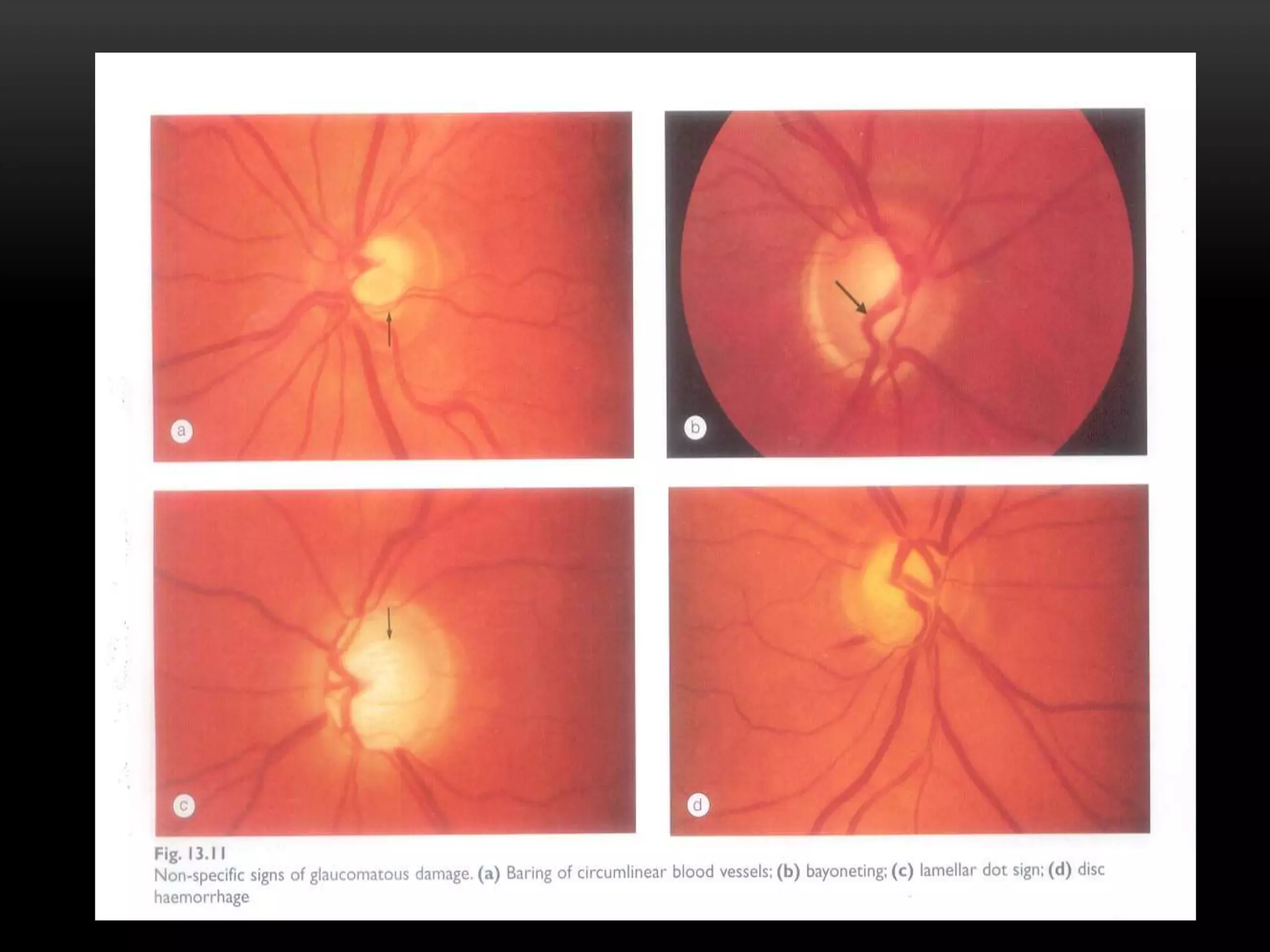 Primary open angle glaucoma (poag) | PPTX