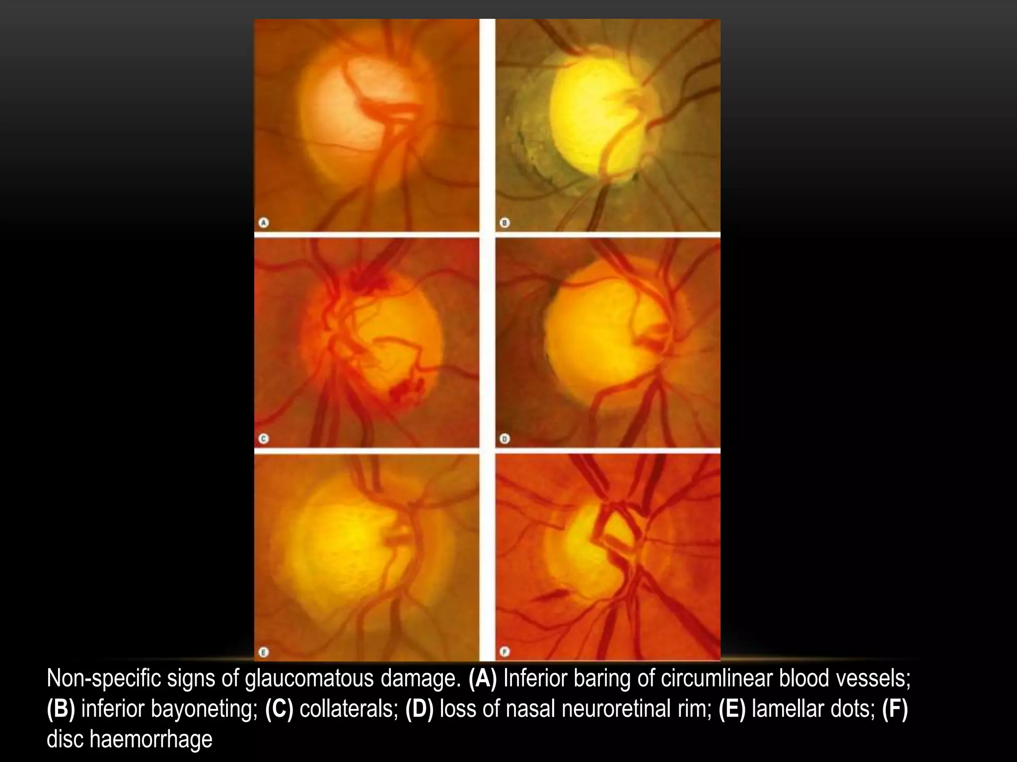 Primary open angle glaucoma (poag) | PPTX