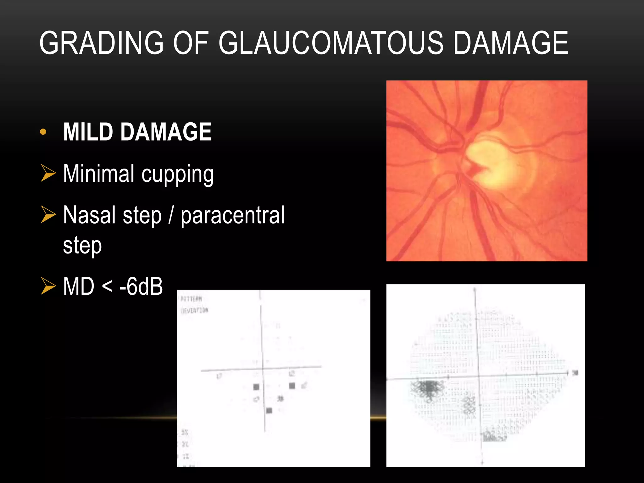 Primary open angle glaucoma (poag) | PPTX