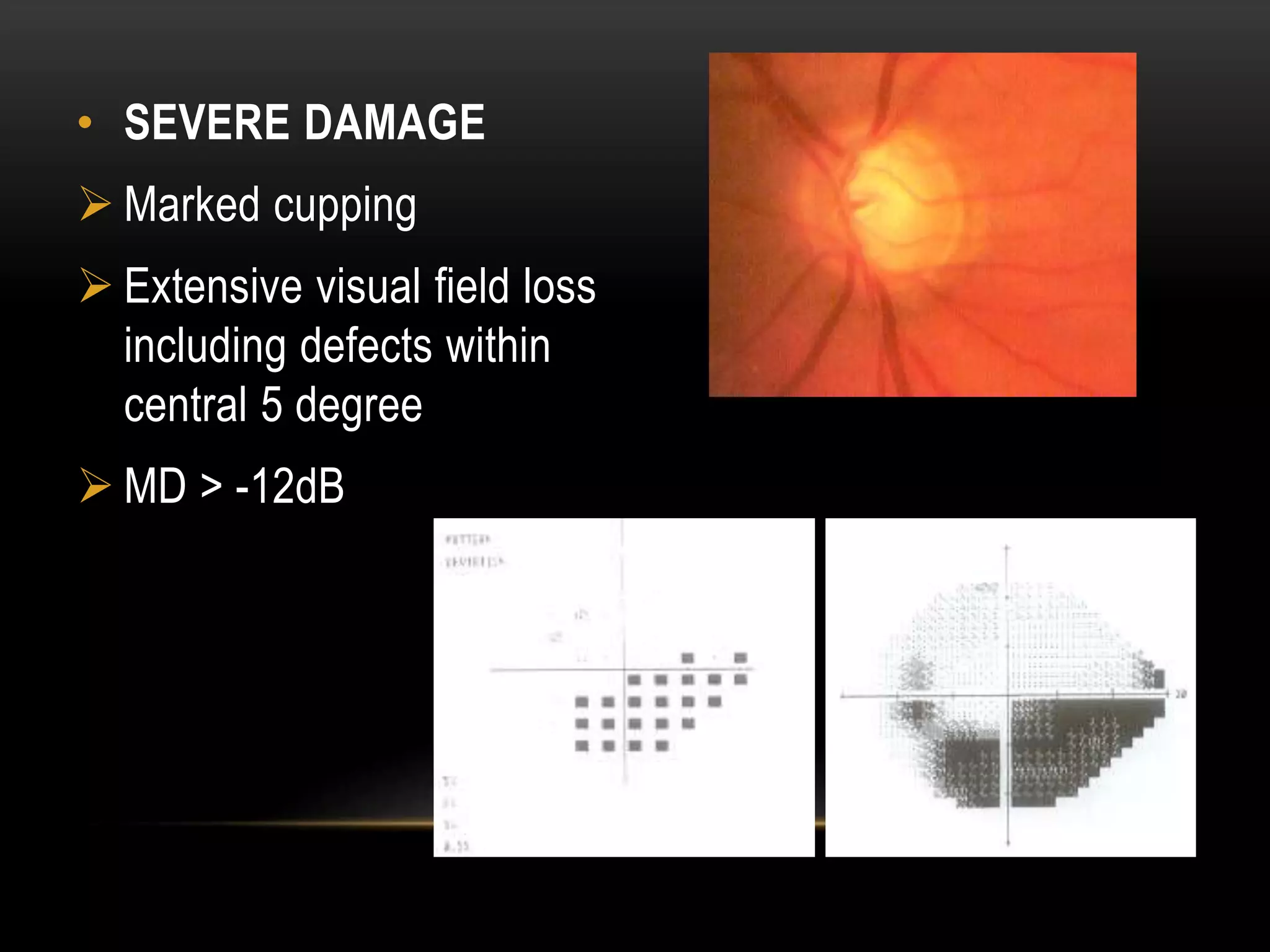 Primary open angle glaucoma (poag) | PPTX
