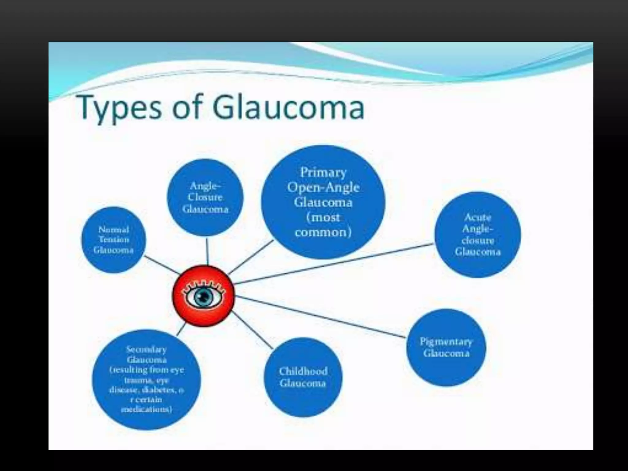 Primary open angle glaucoma (poag) | PPTX