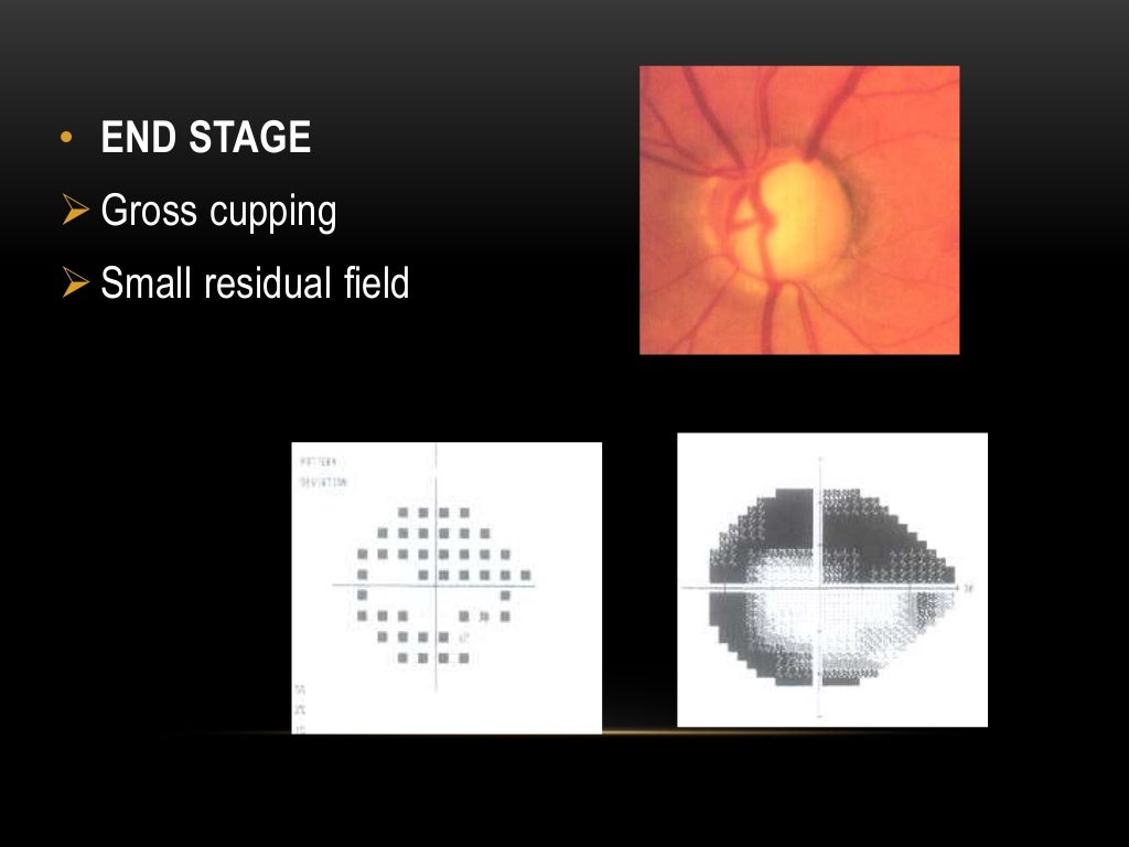 Primary open angle glaucoma (poag) Primary open angle glaucoma (poag)