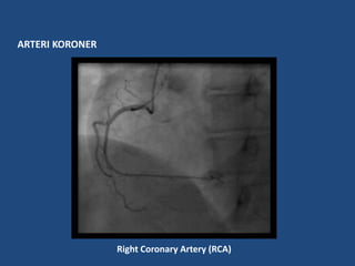 PRIMARY_PCI_PADA_STEMI.ppt
