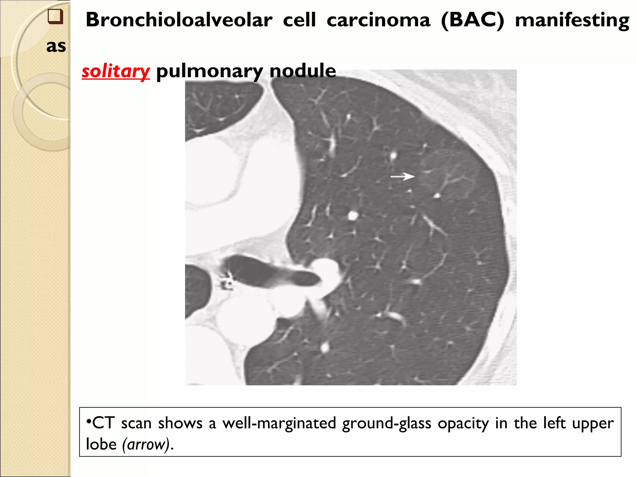 Primary pulmonary neoplasm | PPT