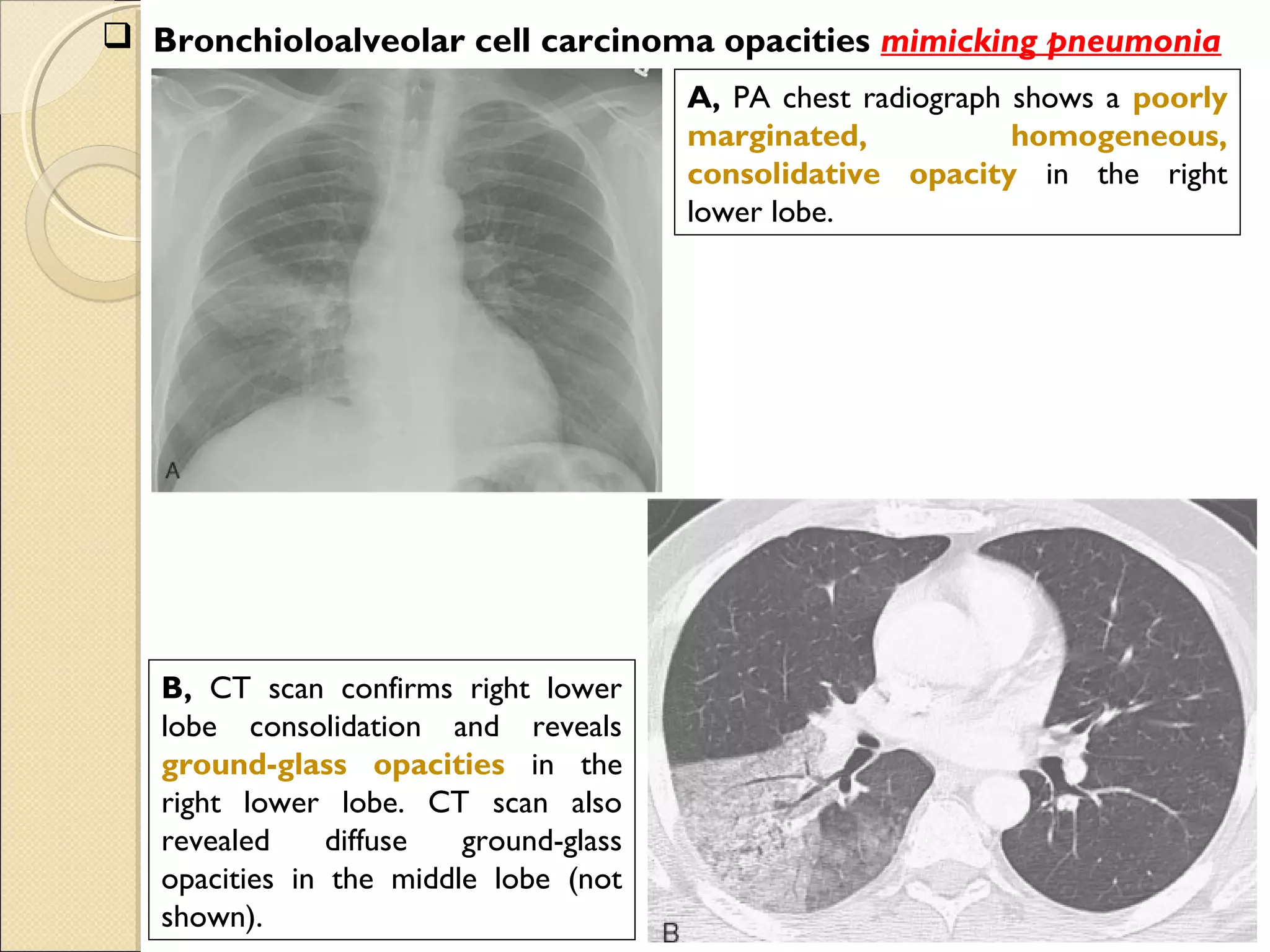 Primary pulmonary neoplasm | PPT