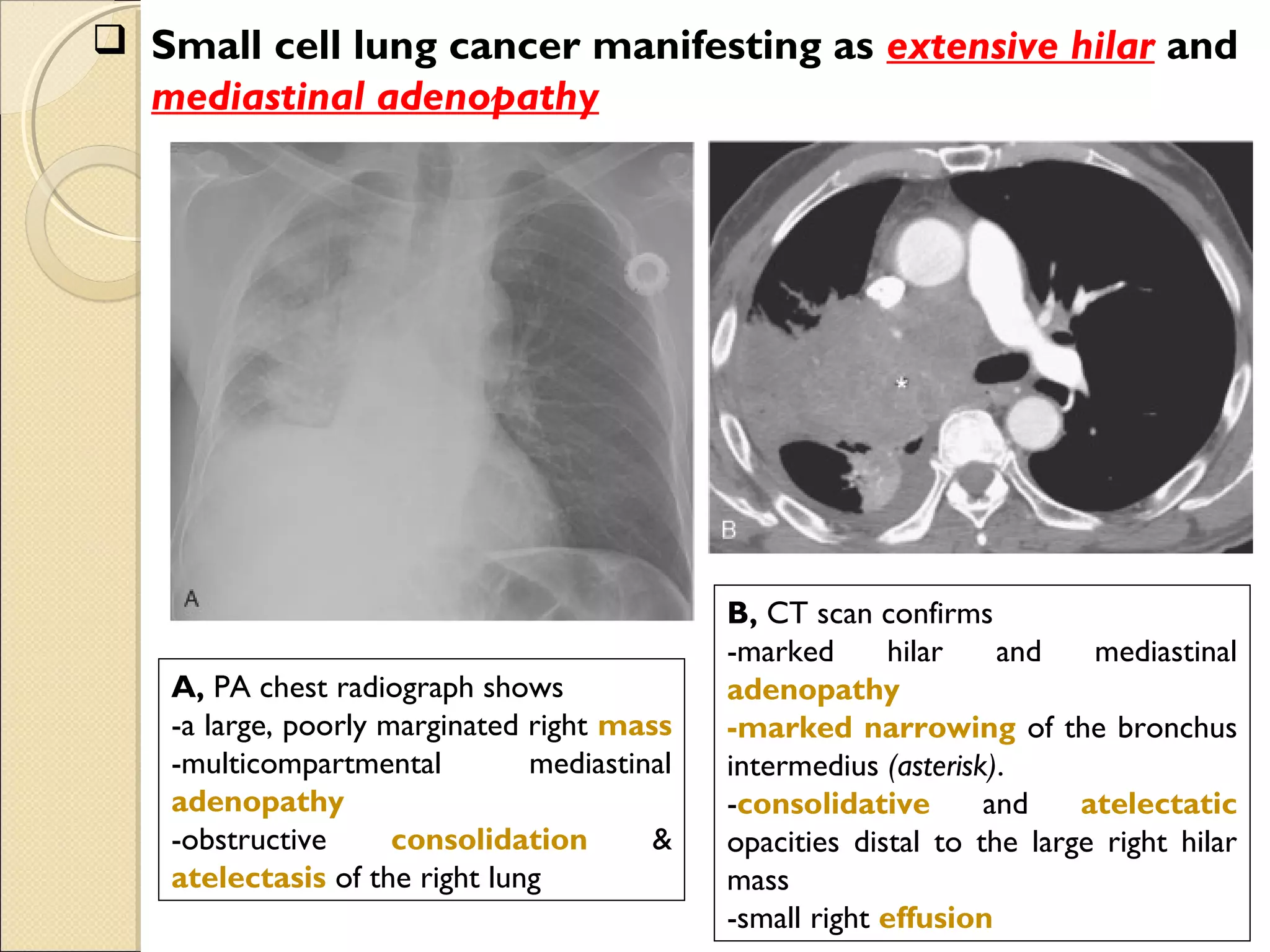 Primary pulmonary neoplasm | PPT
