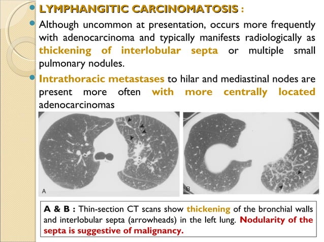 Primary pulmonary neoplasm | PPT | Smoking Cessation | Wellness