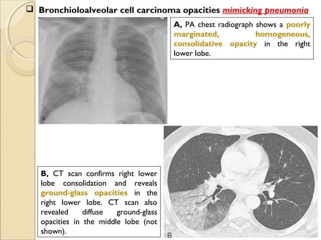 Primary pulmonary neoplasm | PPT | Smoking Cessation | Wellness