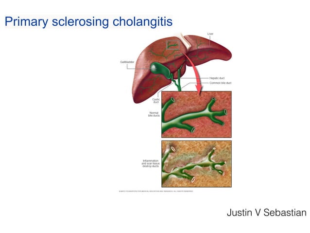 Primary sclerosing cholangitis | PPT