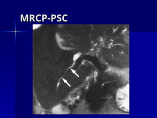 Primary Sclerosing Cholangitis management the lect .ppt