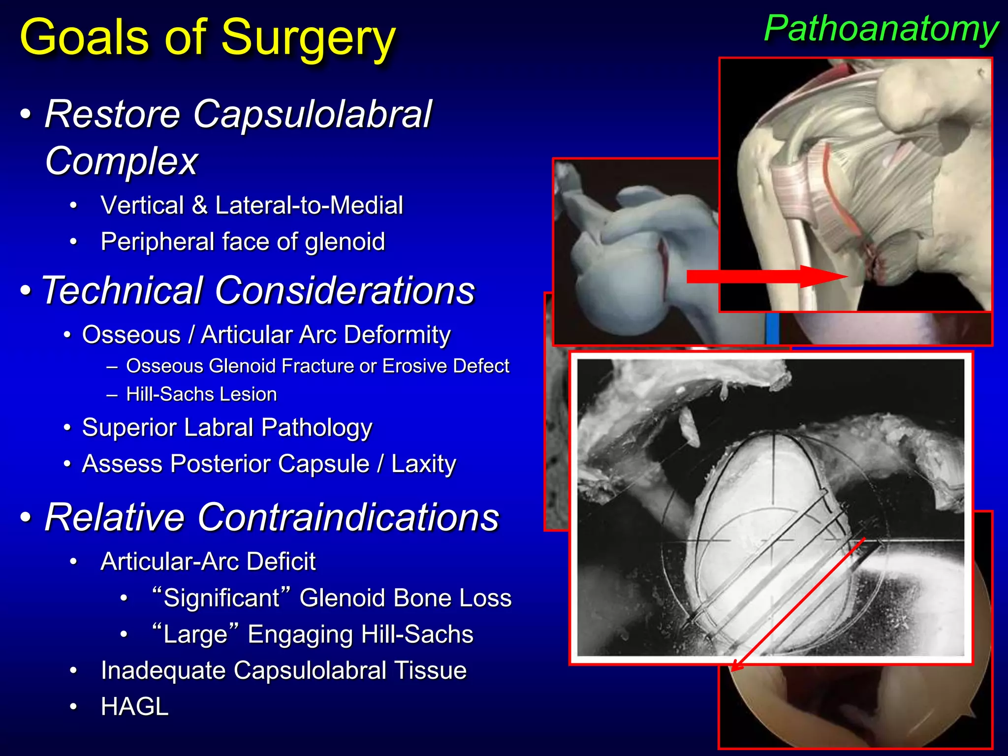 Management of Primary Traumatic Shoulder Instability | PPTX