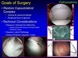 Management of Primary Traumatic Shoulder Instability | PPTX