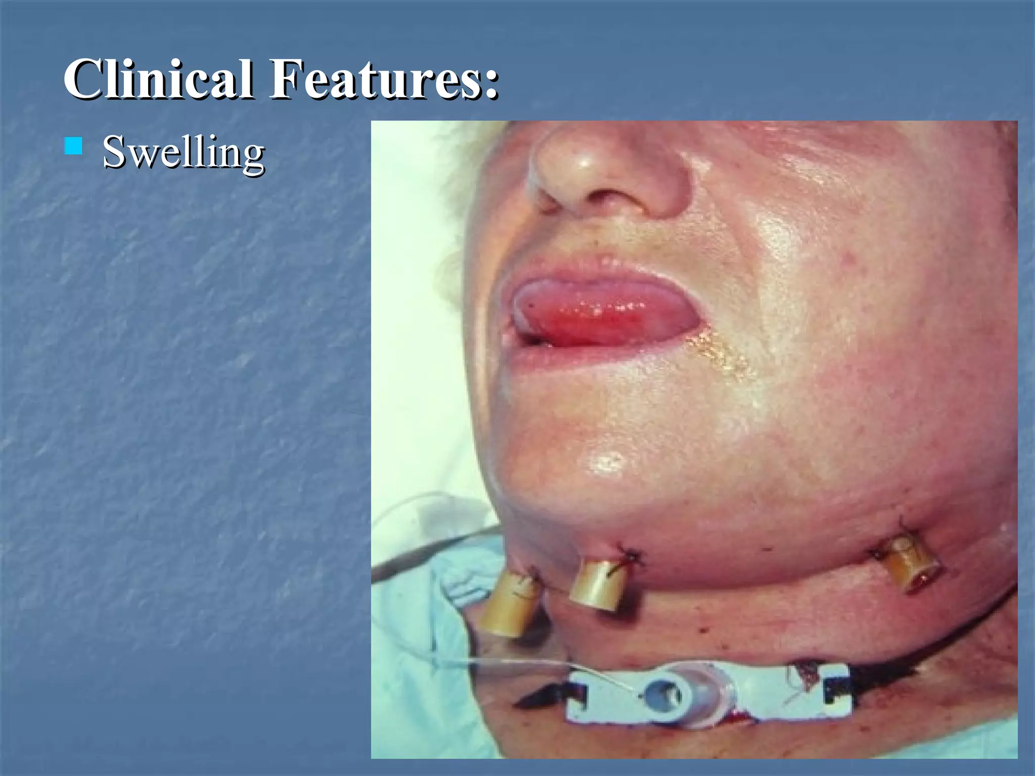 Primary spaces infection | PPT