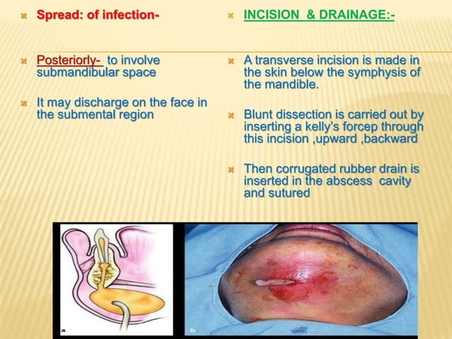 Primary spaces of space infection | PPTX | Ear, Nose and Throat ...