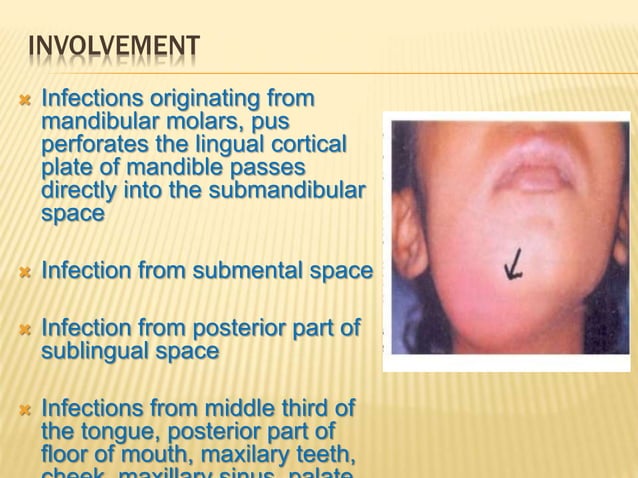 Primary spaces of space infection | PPTX | Ear, Nose and Throat ...