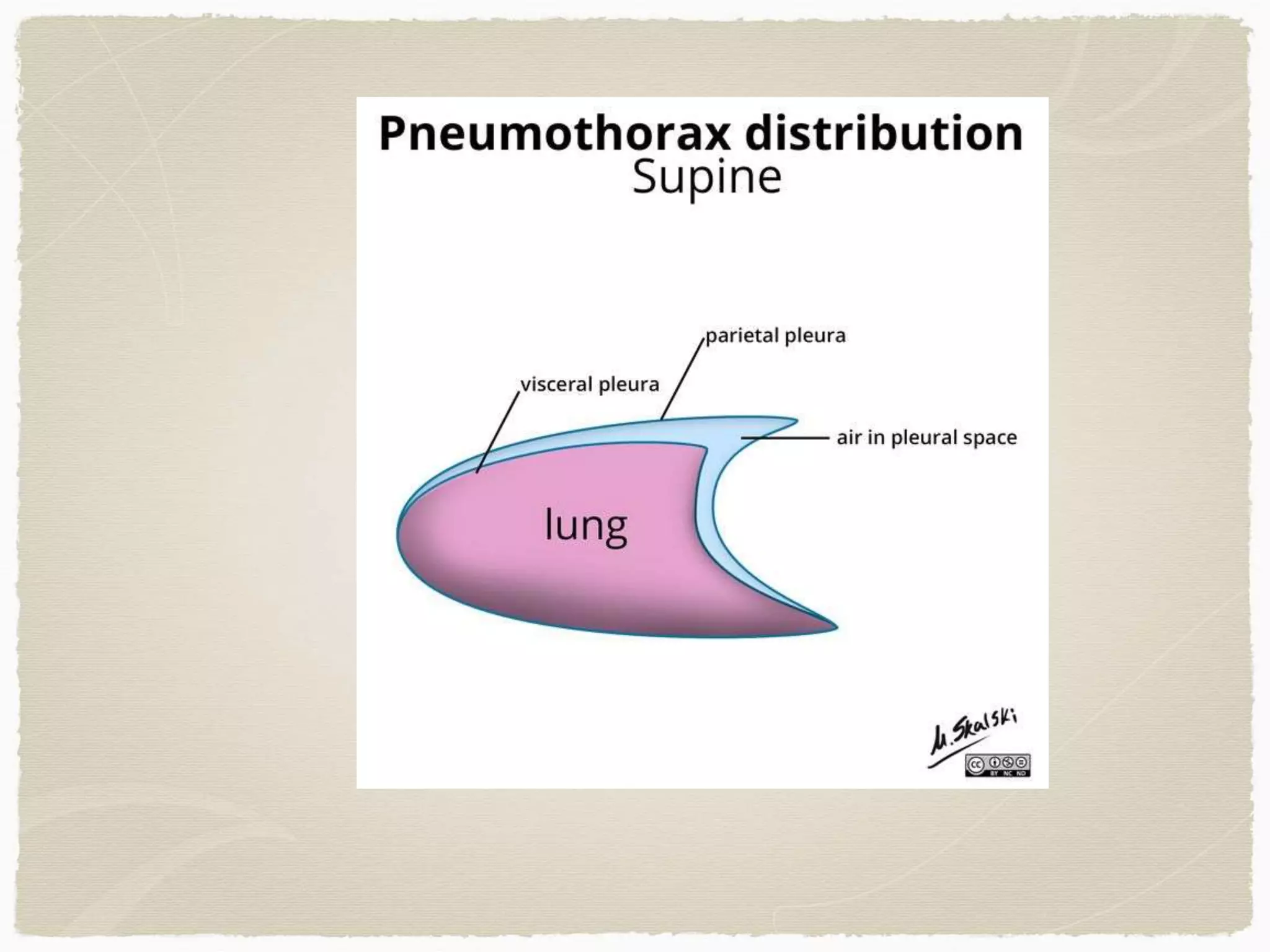 Primary spontaneous pneumothorax.pptx