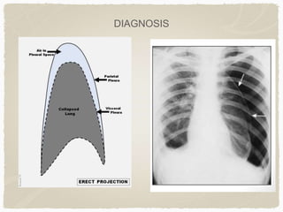 Primary spontaneous pneumothorax.pptx