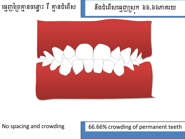 Spacing and primary teeth | PPT
