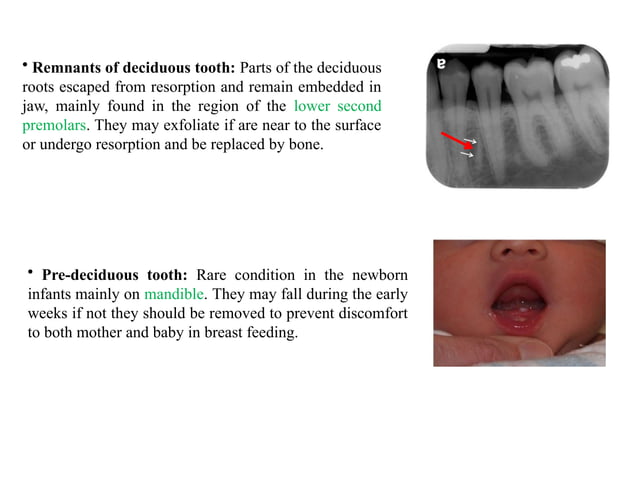 Primary teeth in Comparision to permanent dention .pptx | Oral care ...