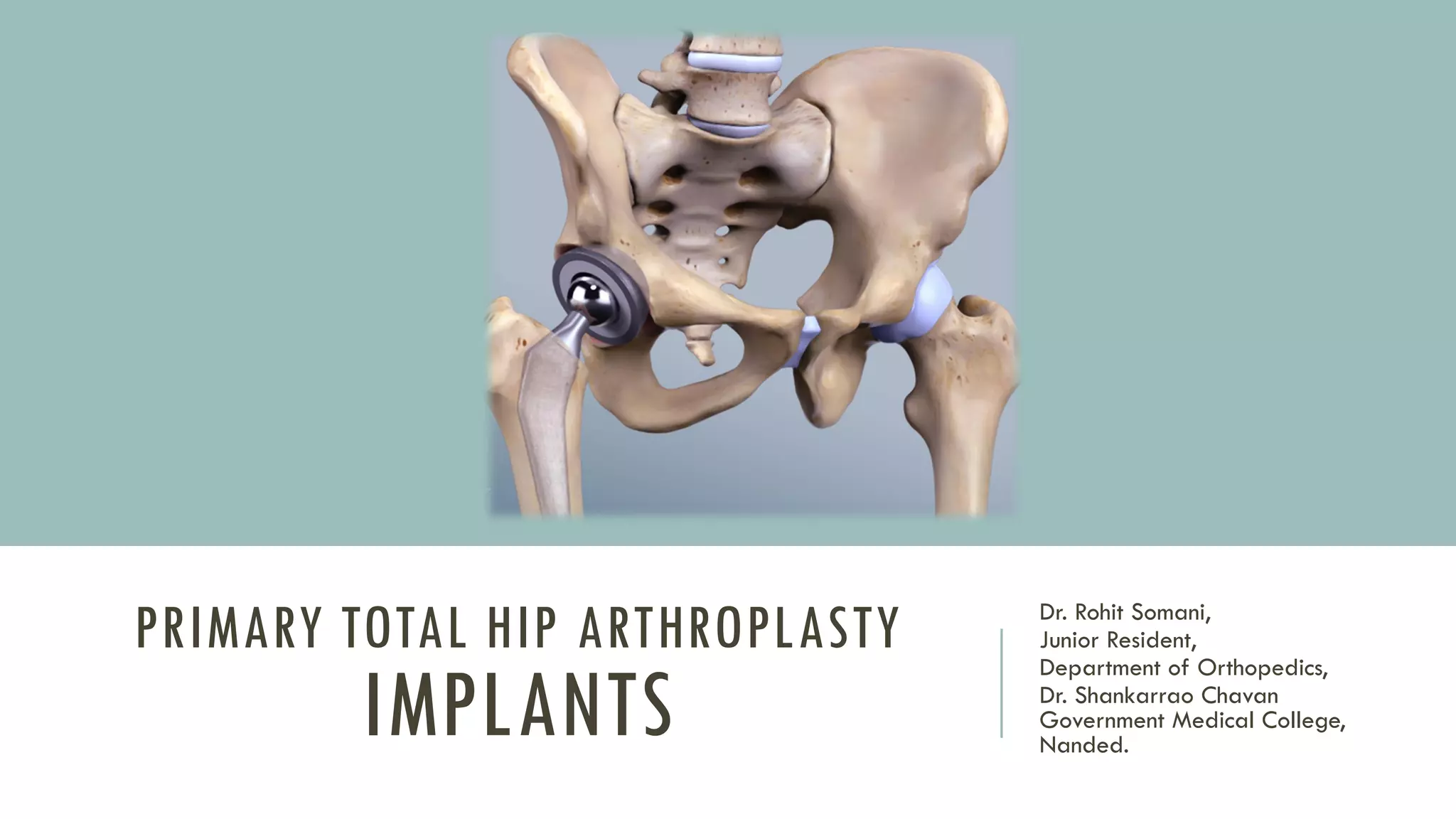 Primary total hip arthroplasty - IMPLANTS | PDF