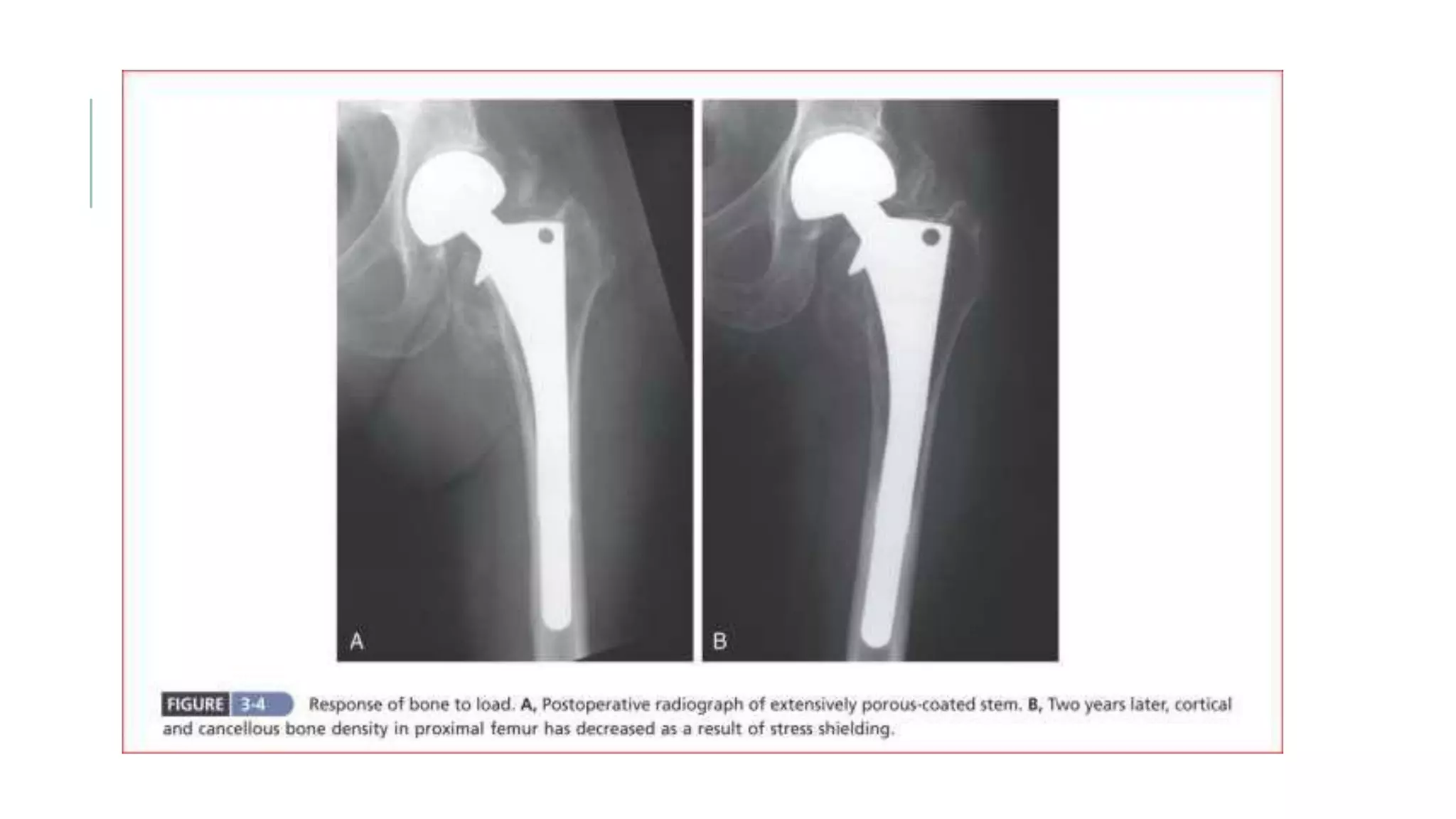 Primary total hip arthroplasty - IMPLANTS | PDF