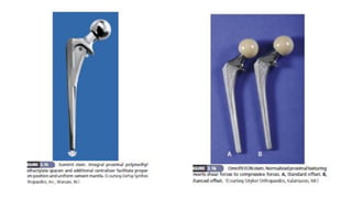Primary total hip arthroplasty - IMPLANTS | PDF
