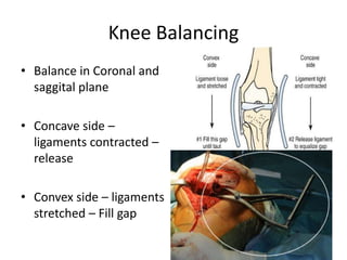 Primary total knee arthroplasty | PPTX