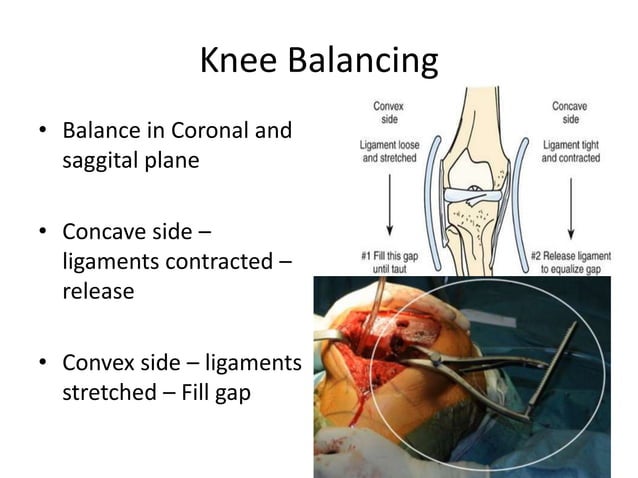Primary total knee arthroplasty | PPT
