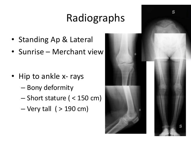 Primary total knee arthroplasty