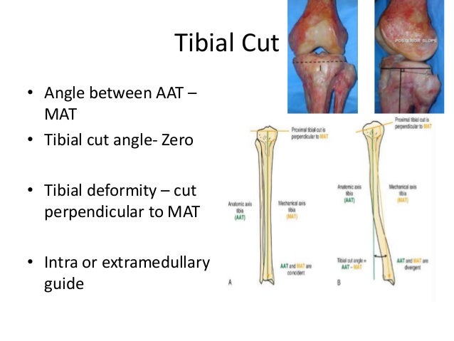 Primary total knee arthroplasty