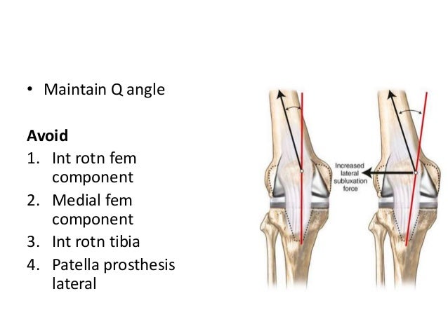 Primary total knee arthroplasty