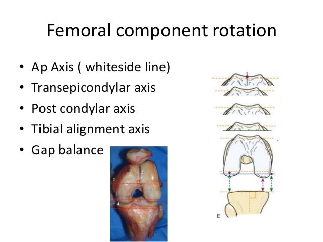 Primary total knee arthroplasty