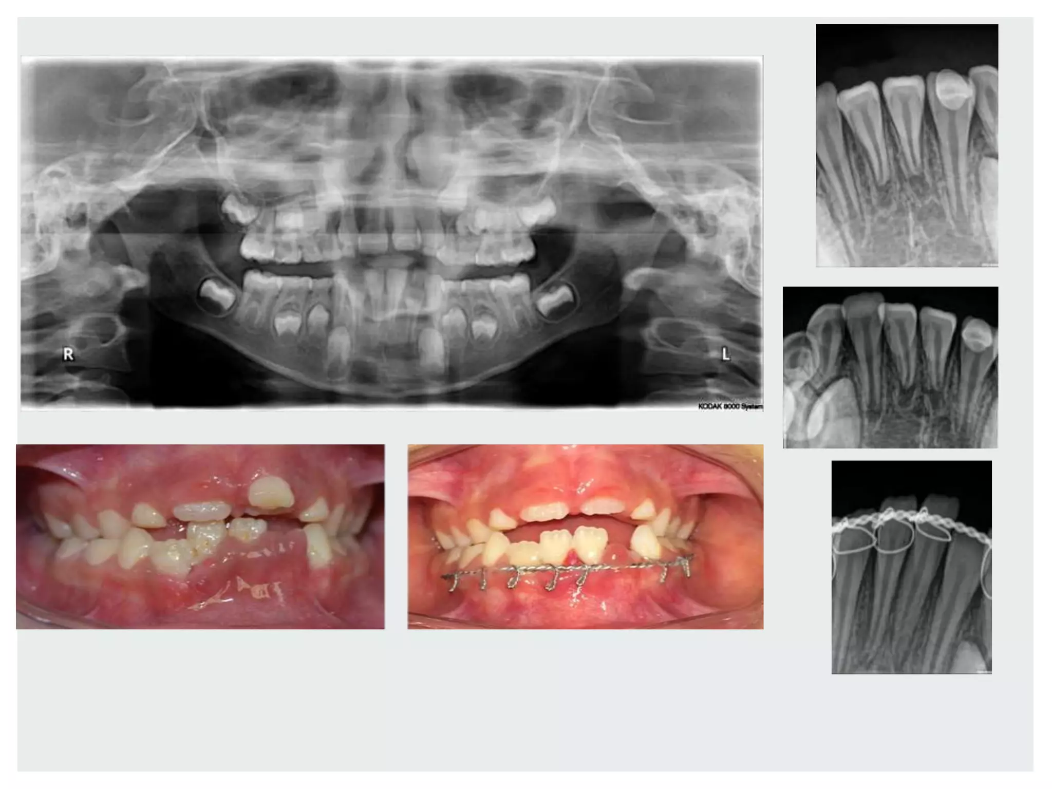 Primary teeth trauma managment | PPTX