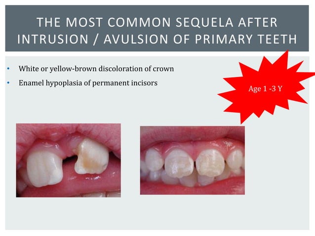 Primary teeth trauma managment | PPTX