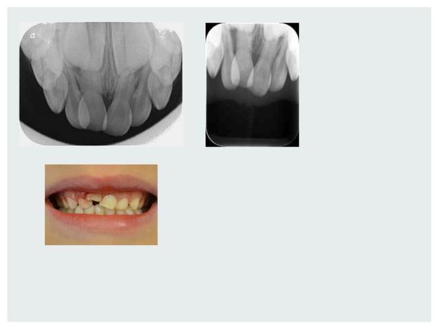 Primary teeth trauma managment | PPTX