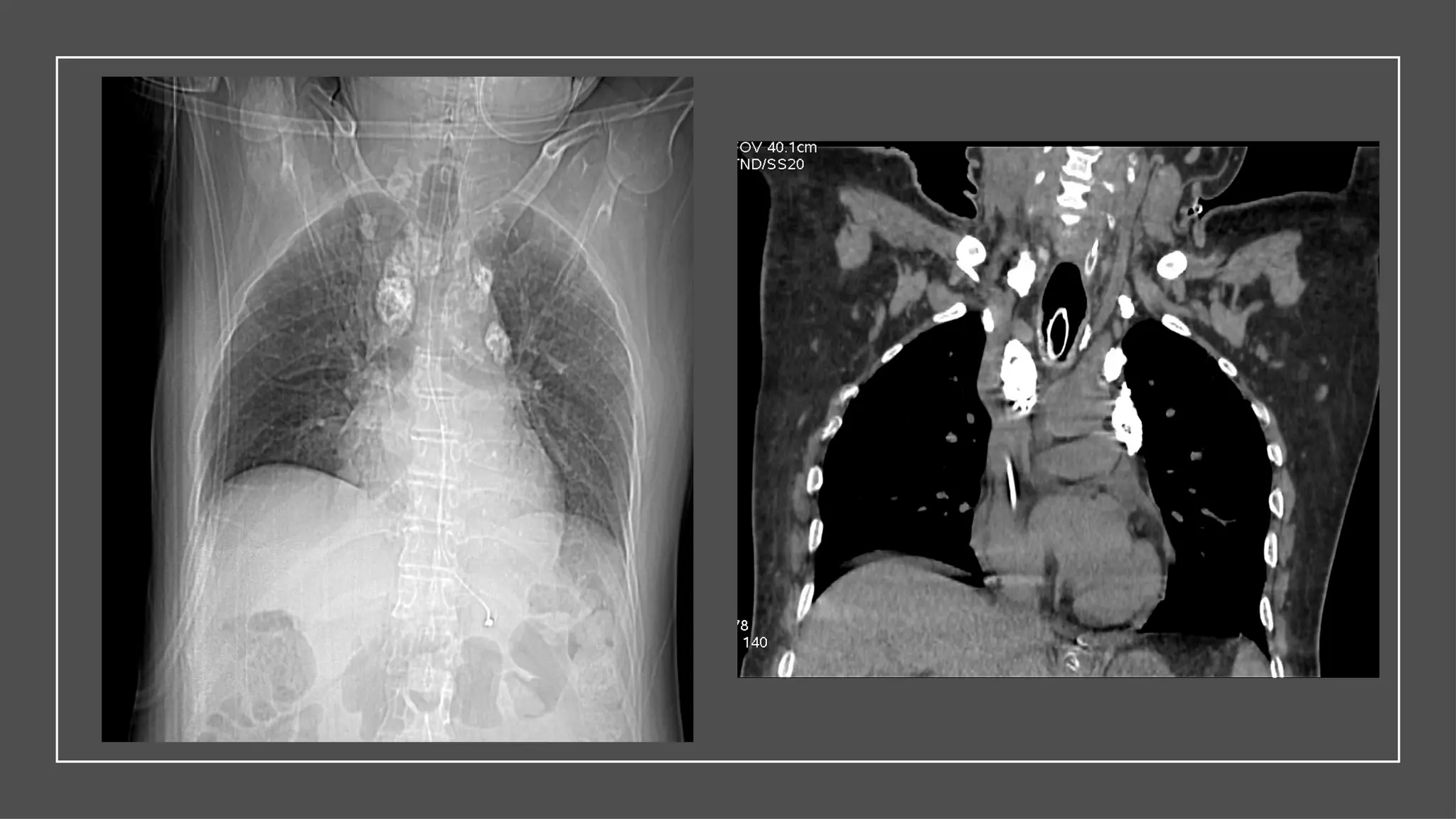 Primary Tuberculosis (pediatric TB).pptx