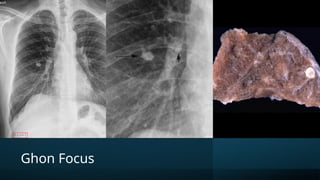 Primary Tuberculosis (pediatric TB).pptx
