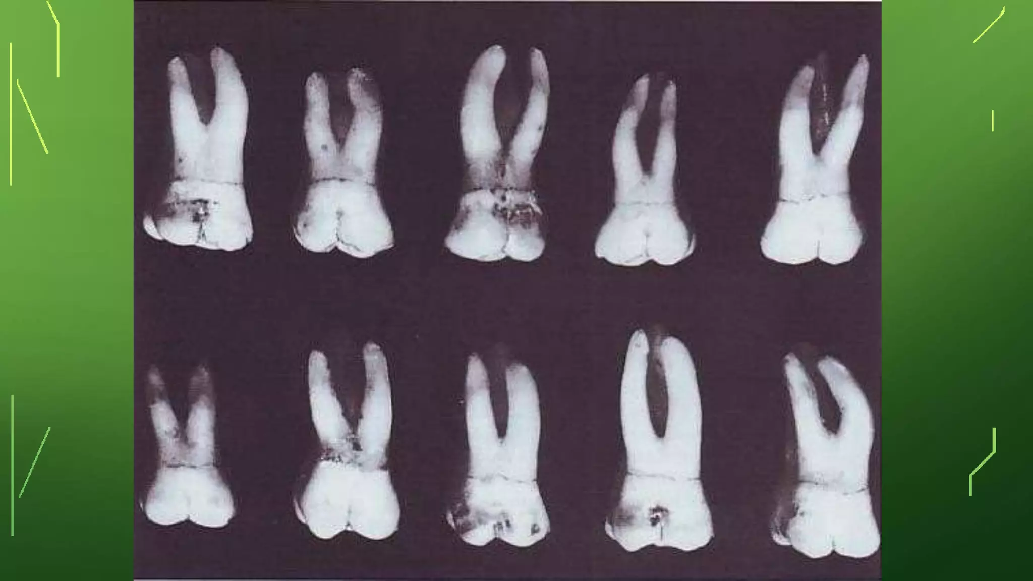 Primer molar superior | PPTX | Ear, Nose and Throat Conditions ...
