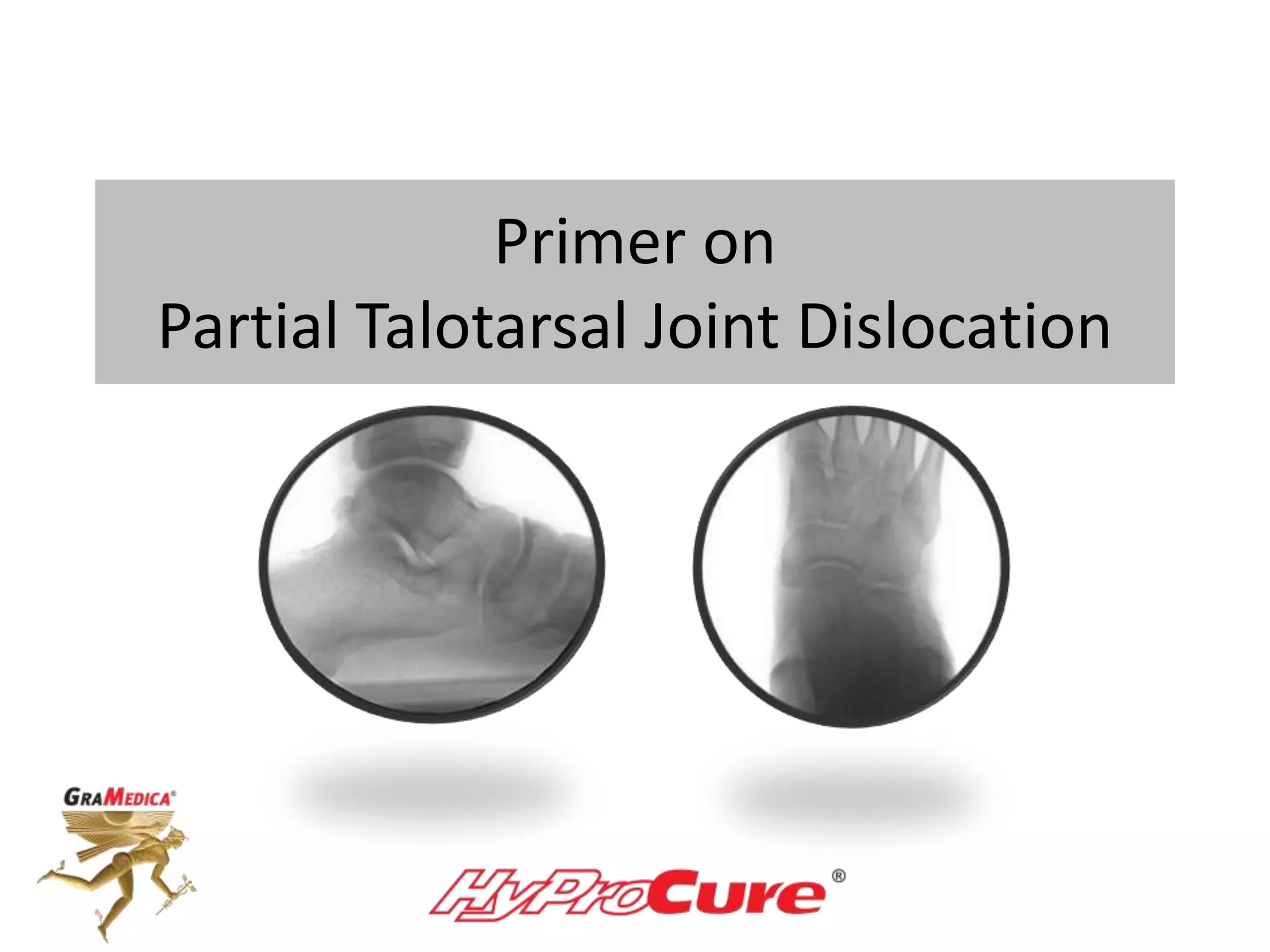 Understanding Talotarsal Displacement | PPTX
