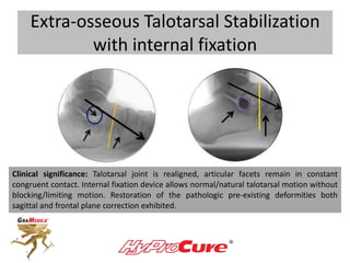 Understanding Talotarsal Displacement | PPT